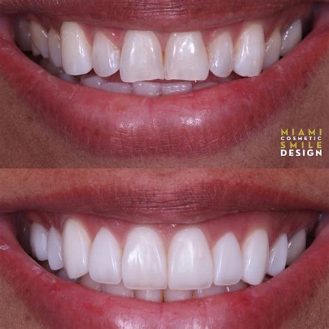 How to Use a Natural Tooth Color Chart to Match Your Smile ...